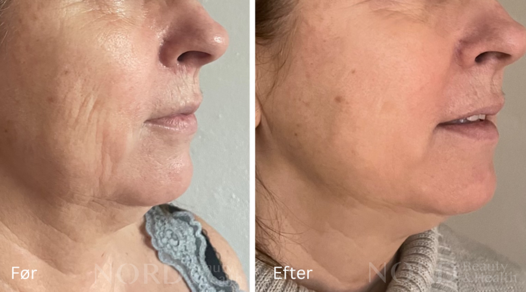 EM Shaper Face - EM Shaper