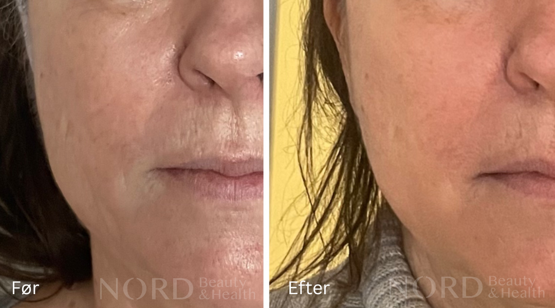 EM Shaper Face - EM Shaper