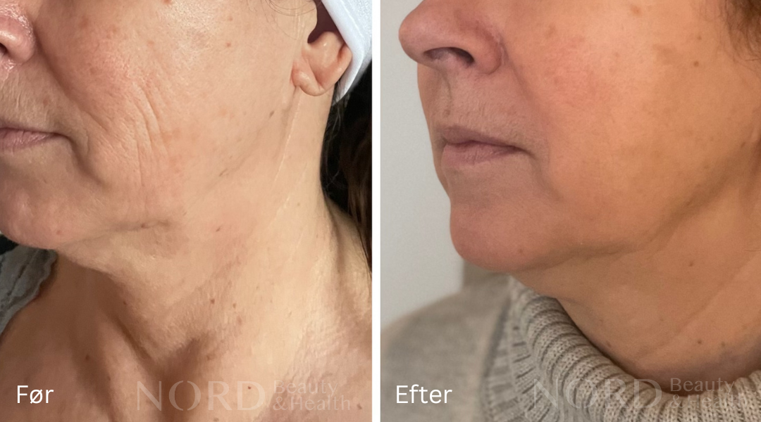 EM Shaper Face - EM Shaper