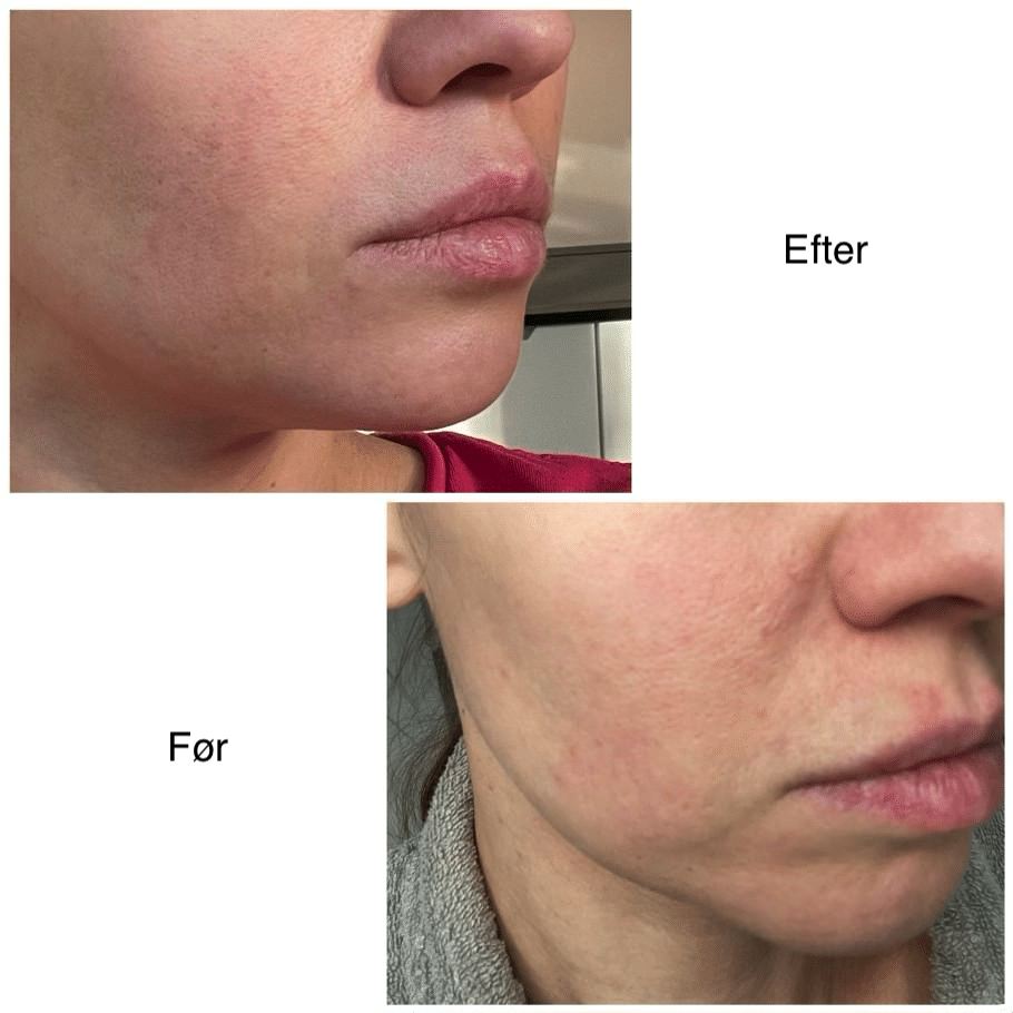 EM Shaper Face - EM Shaper