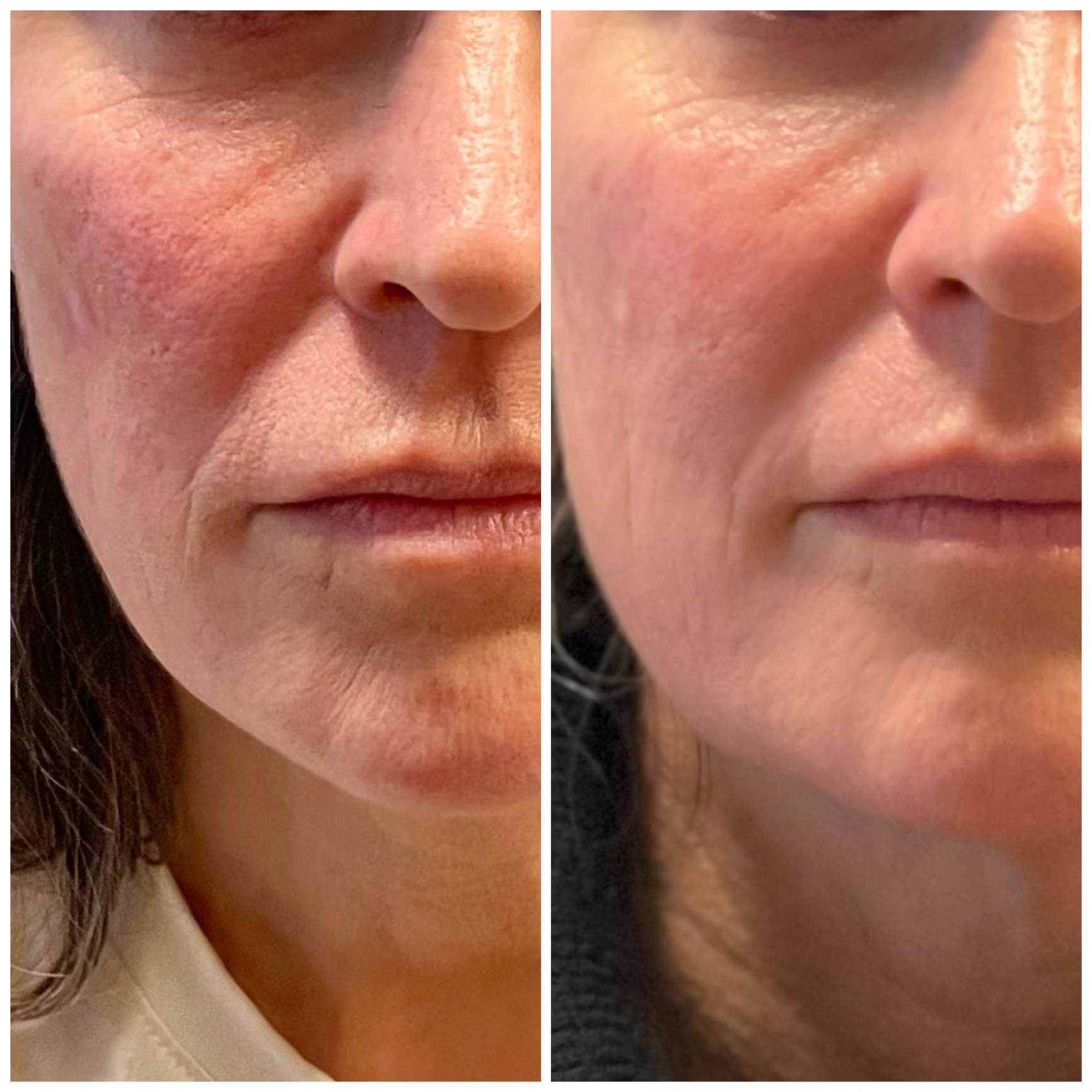 EM Shaper Face - EM Shaper